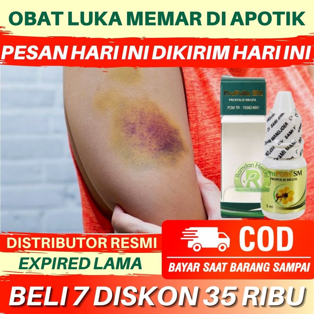 Jual Obat Luka Memar Di Apotik Penghilang Memar Obat Oles Luka Memar ...