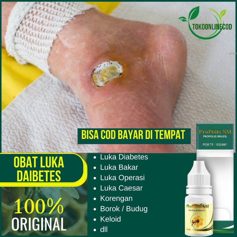 Jual Obat Luka Diabetes Basah Bernanah Gangren Cepat Kering di Kaki ...