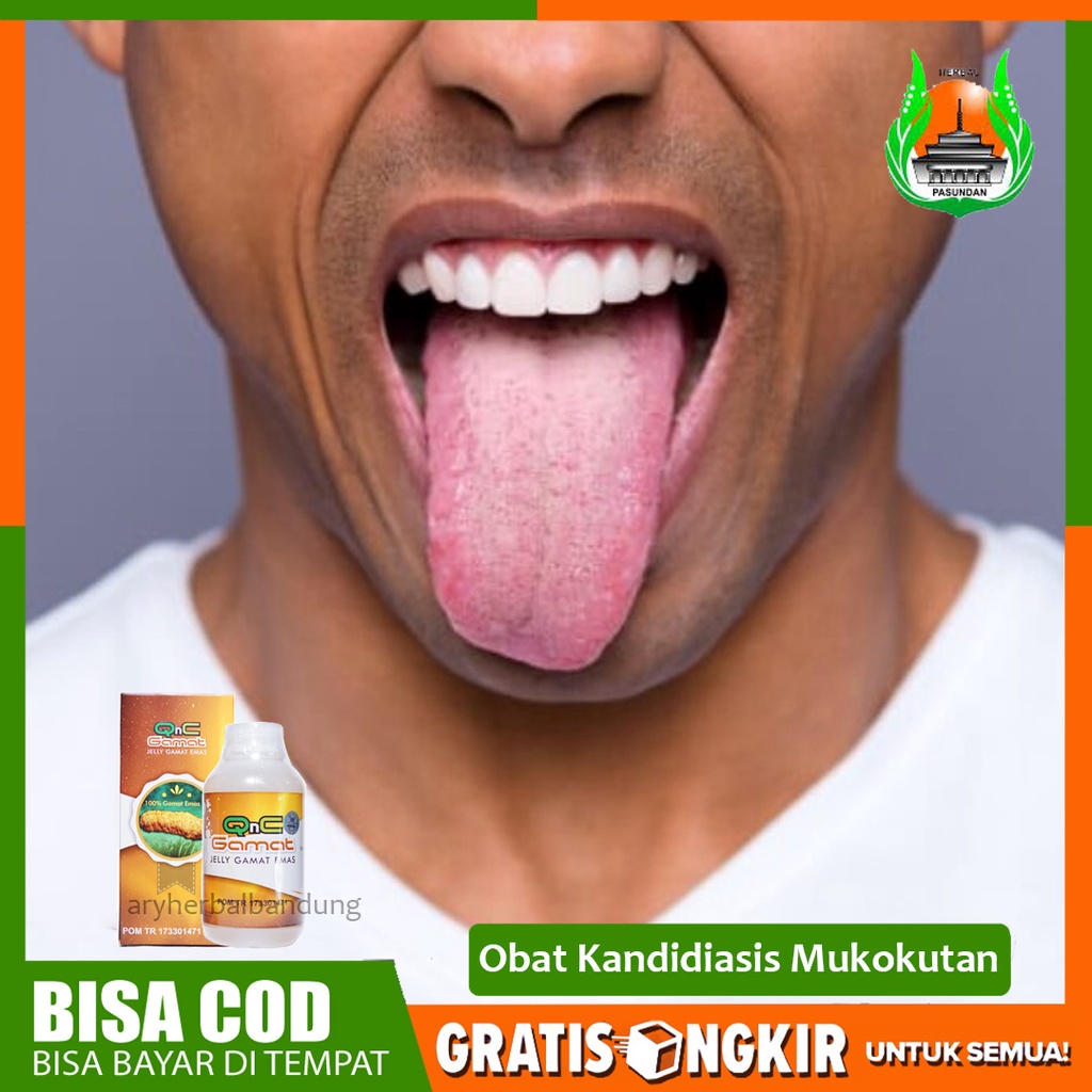 Jual Obat Kandidiasis Mukokutan, Infeksi Jamur Candida, Lidah Putih ...