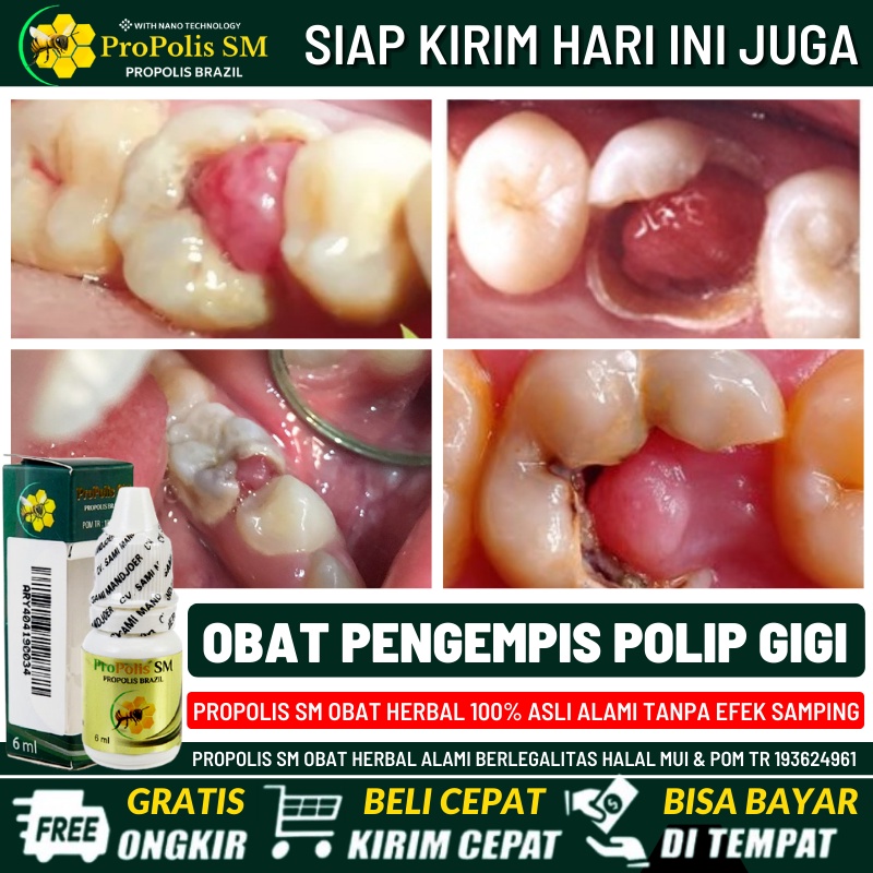 Jual Obat Tetes Polip Gigi 100% Alami, Obat Polip Gigi Anak, Obat Polip ...