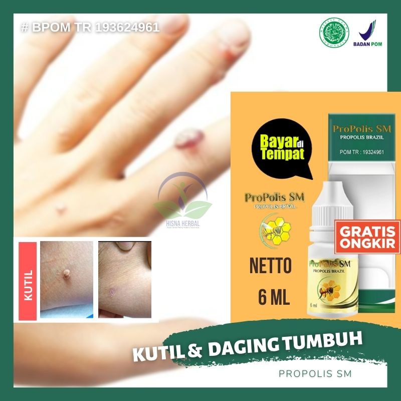 Jual Jual Obat Penyakit Kulit Kelamin - Kutil Jamur - HPV - Cengger ...
