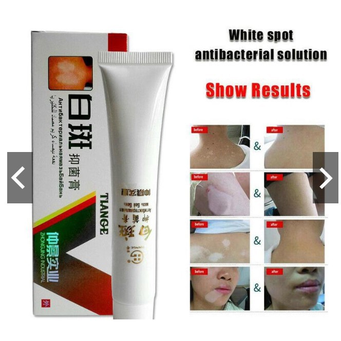 Jual Salep Vitiligo Mengatasi Kulit Belang Salep Cina | Shopee Indonesia
