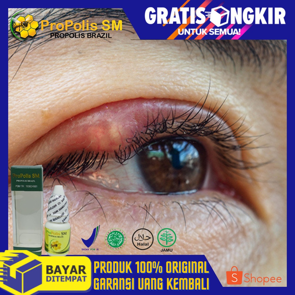 Jual Obat Oles Penghilang Timbilan, Obat Benjolan Di Kelopak Mata, Oles ...