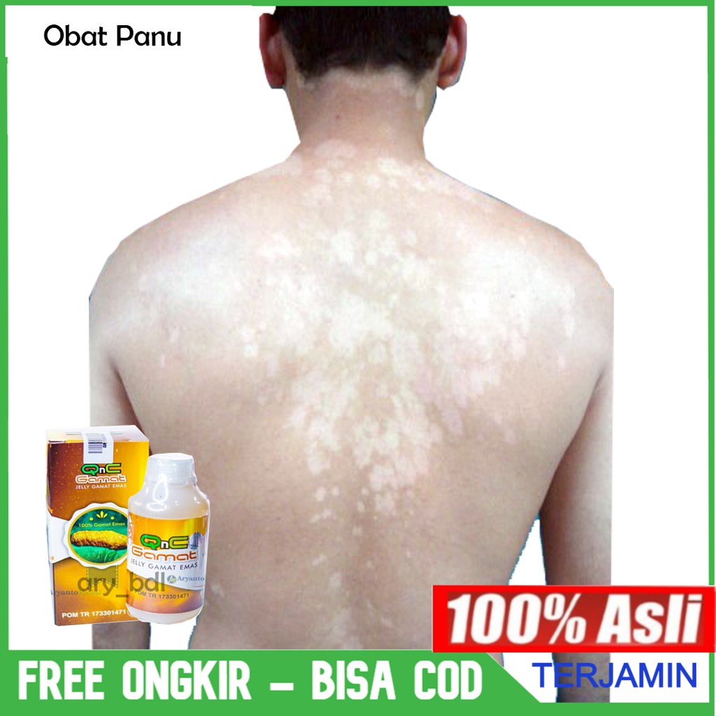 Jual Obat Panu Menahun di Leher Punggung Selangkangan dan Bagian Tubuh ...