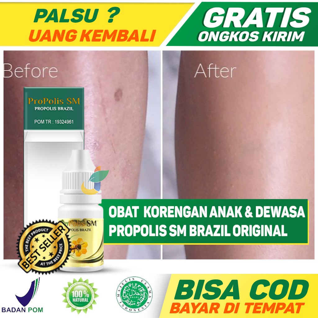 Jual Obat Korengan di Kaki - Korengan di Kepala - Korengan di Wajah ...