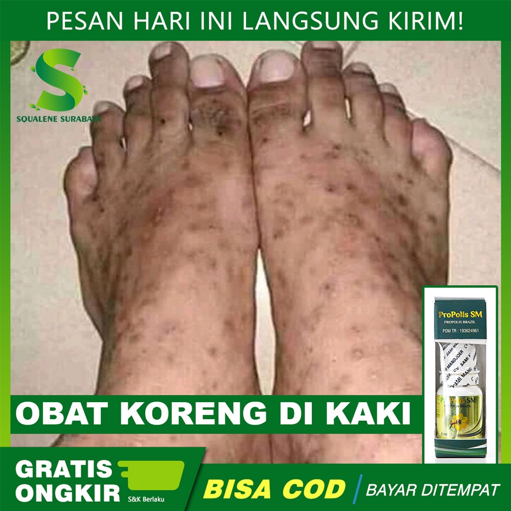 Jual Obat Penghilang Koreng di Kaki, Penghilang Bekas Luka di Kaki ...