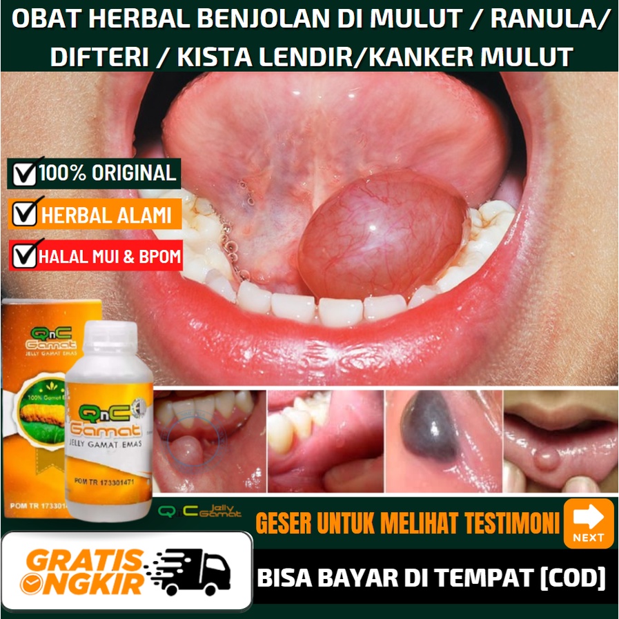 Jual Obat Herbal Alami Benjolan di Mulut, Atasi Penyakit Ranula ...