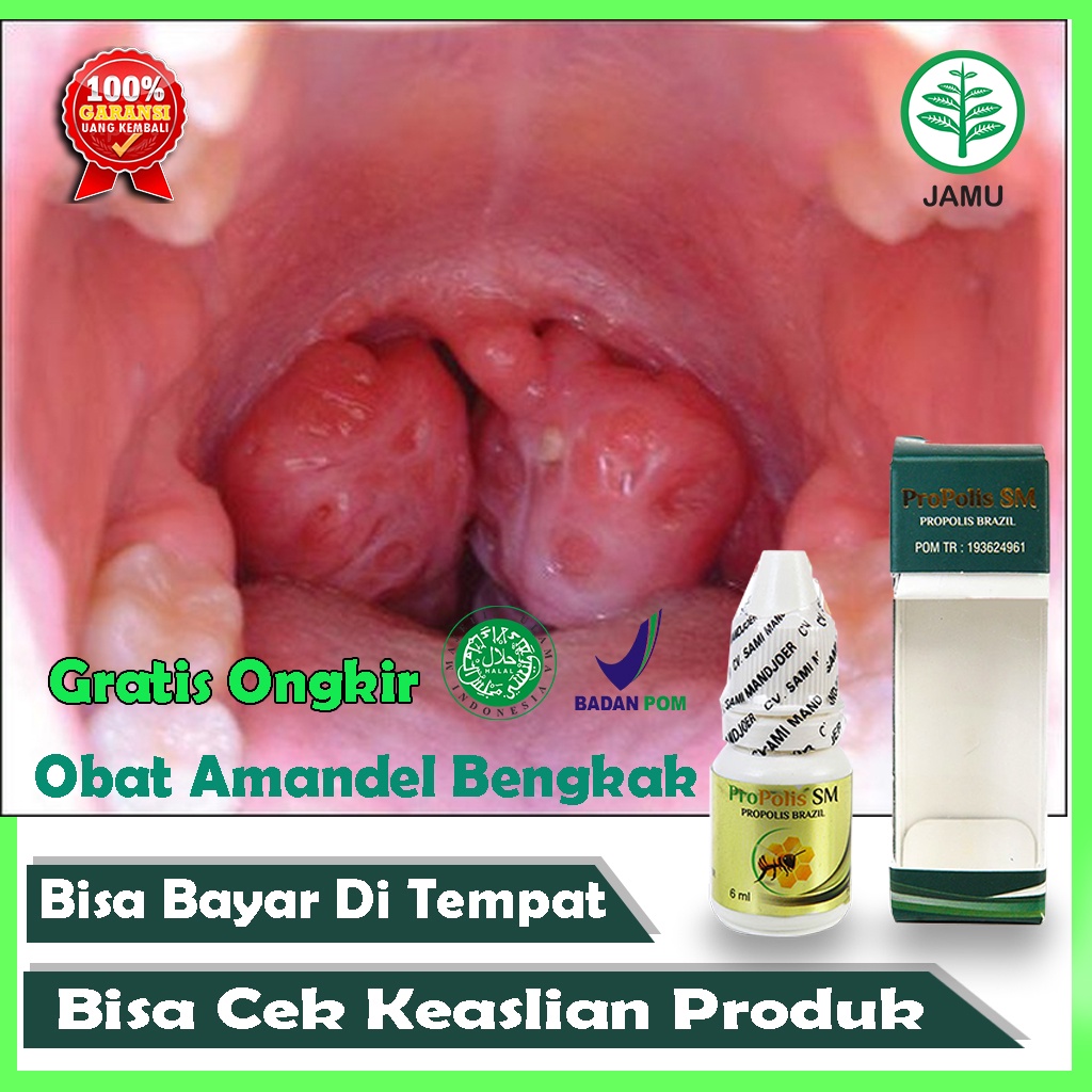 Jual Obat Amandel Bengkak - Radang - Tonsilitis - Aman untuk Anak, Dewasa & Ibu Hamil - Propolis ...