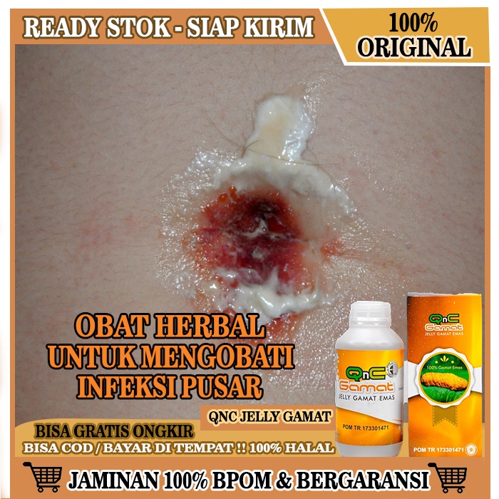 Jual Obat Pusar Bernanah, Pusar Nyeri & Mengeluarkan Cairan Bau, Obat ...
