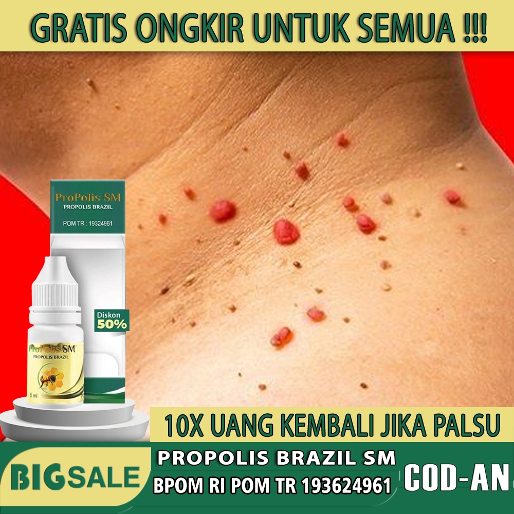 Jual Obat Papiloma, Obat Pailoma di Leher, Obat Papiloma di Leher dan ...