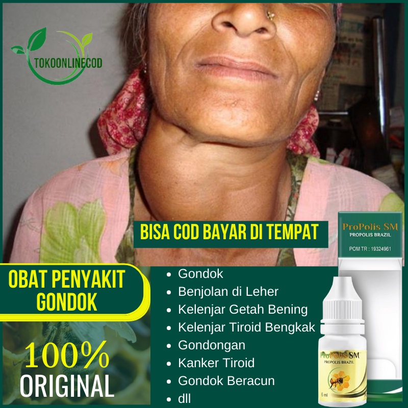 Jual Obat Pengempis Gondok, Benjolan di Leher, Pembengkakan Kelenjar ...