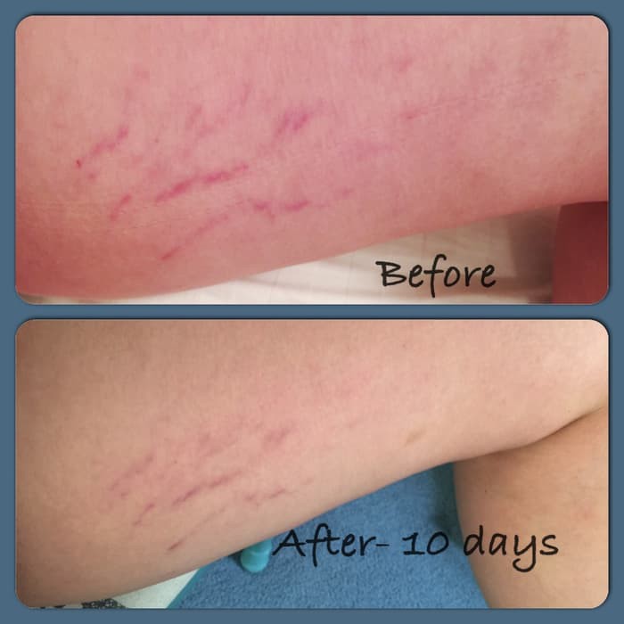 Jual Unik VIENNA STRETCH MARK VIENNA STRETCHMARKS VIENNA SELULIT Murah ...