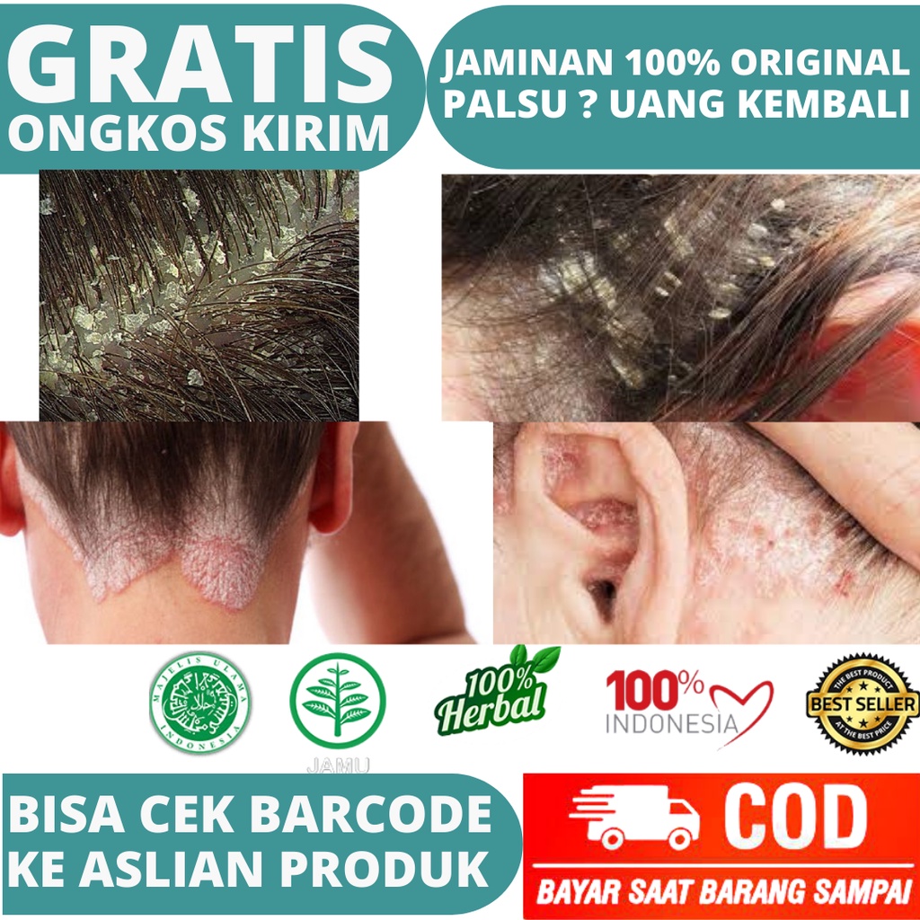 Jual obat ketombe berkerak, Obat Tetes Ketombe Berkerak,obat ketombe ...