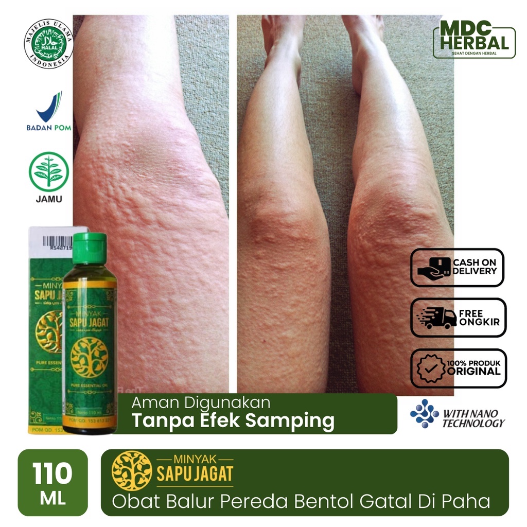 Jual Obat Bentol Gatal Di Paha, Obat Balur Pereda Gatal Alergi, Gatal ...