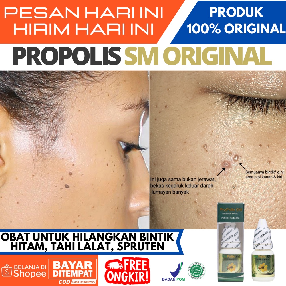 Jual Obat Menghilangkan Bintik Hitam di Wajah Seperti Tahi Lalat ...