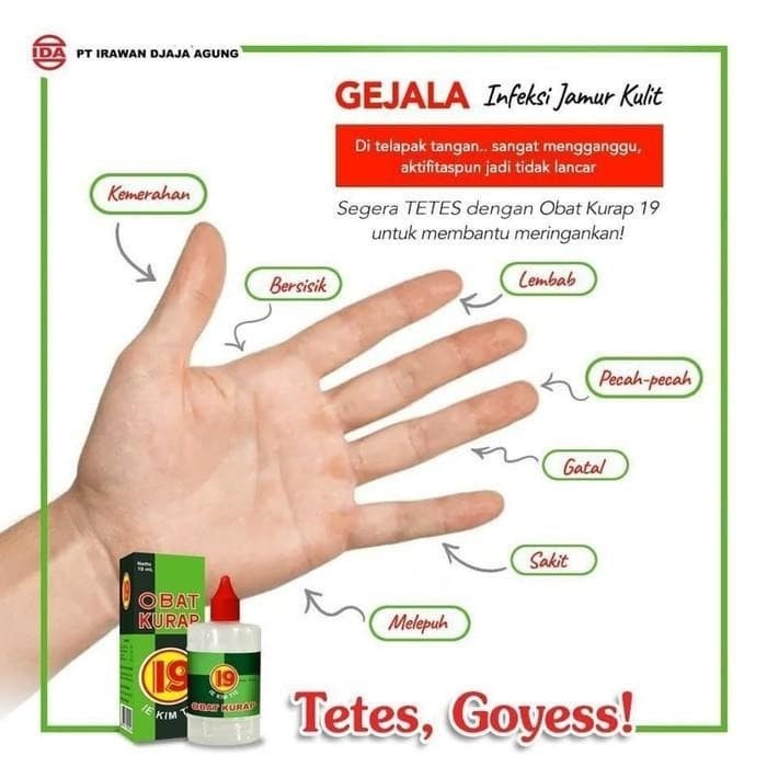 Jual KURAP 19 (Obat Panu Cair Pengganti Kalpanax) | Shopee Indonesia