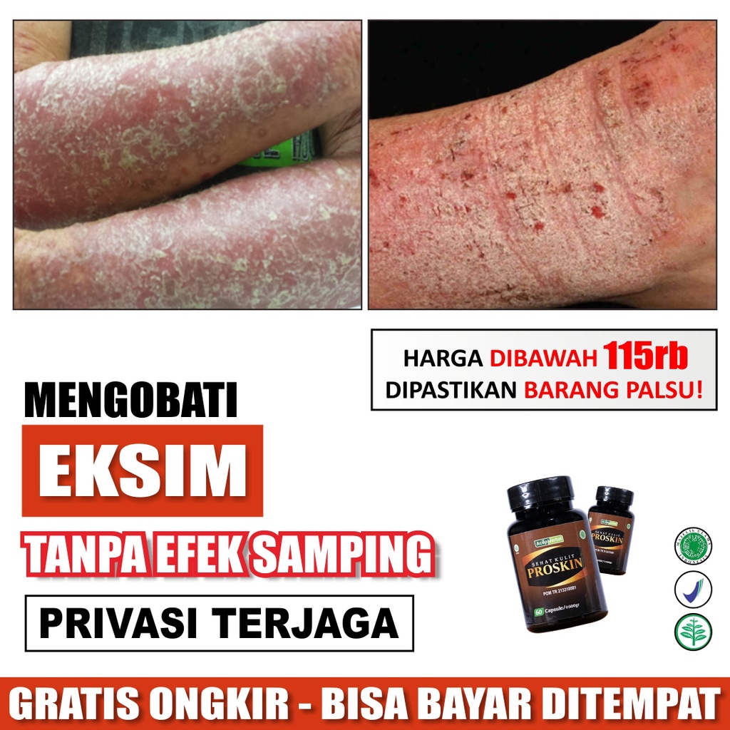Jual Obat Eksim Infeksi Jamur Kering Menahun Alami Scabies Manusia ...