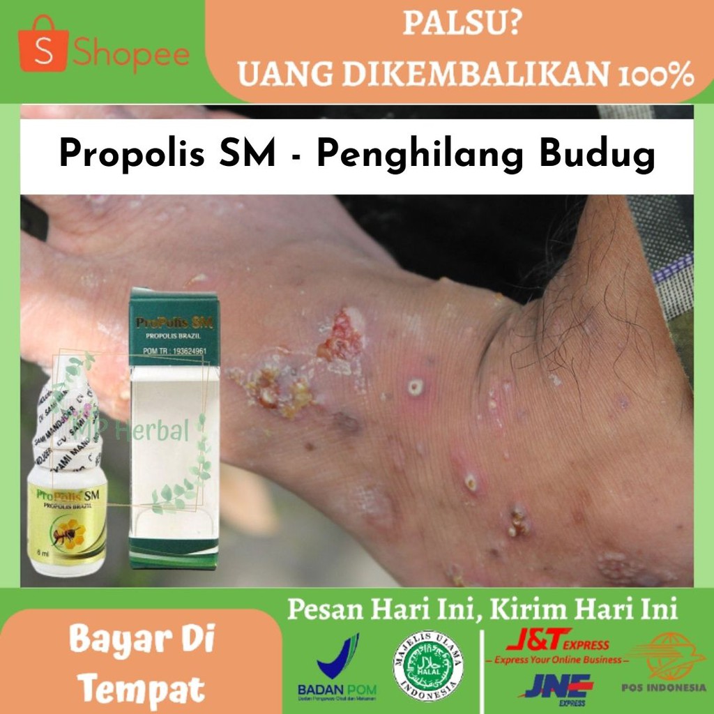 Jual Obat Budug/Buduk, Obat Herbal Scabies Manusia, Penghilang Bekas ...