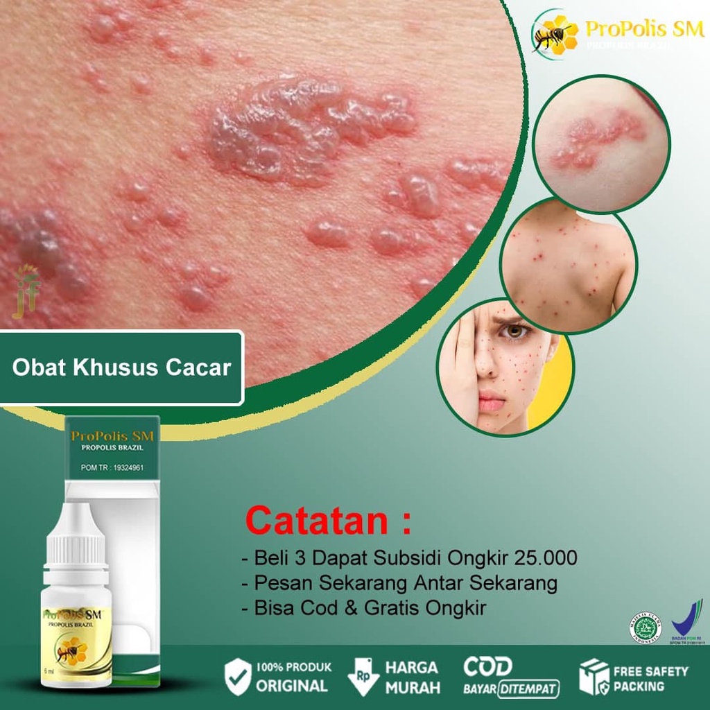 Jual Obat Oles Khusus Cacar, Bernanah, Berair, Bintil Panas, Herpes ...