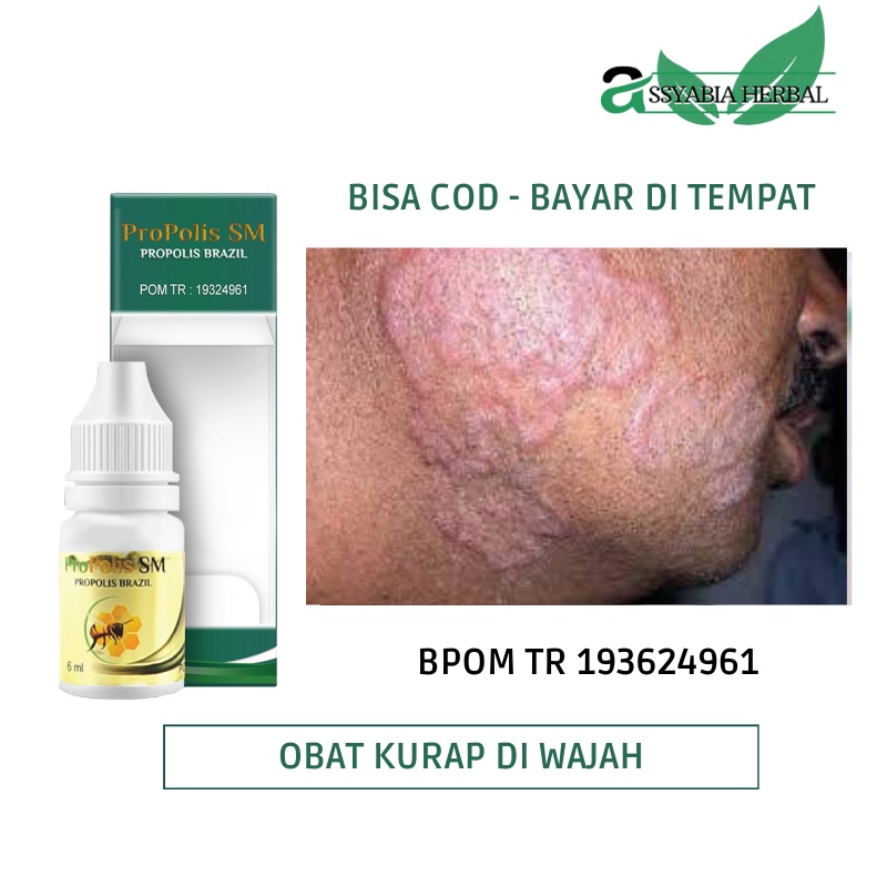 Jual Obat Kurap di Wajah, Penghilang Kurap & Kudis, Tinea Fasialis ...