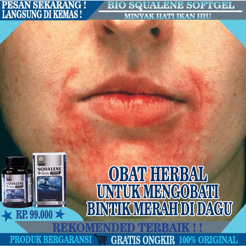 Jual Obat Ruam kemerahan dan Bintik Di Area Dagu Dan Hidung, Obat Alami ...