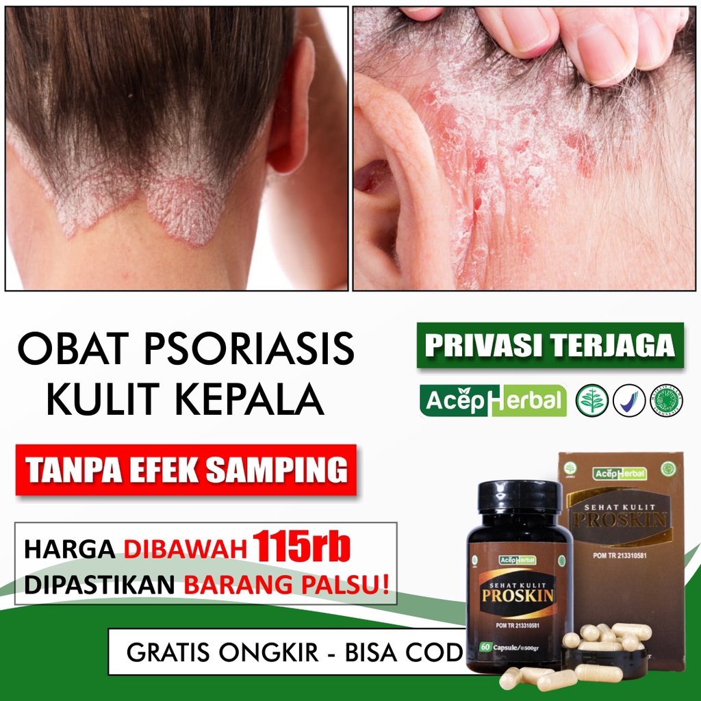 Jual Obat Psioriasis Kulit Kepala Penghilang Gatal Ketombe Dermatitis Folikulitis Kurap Tinea ...
