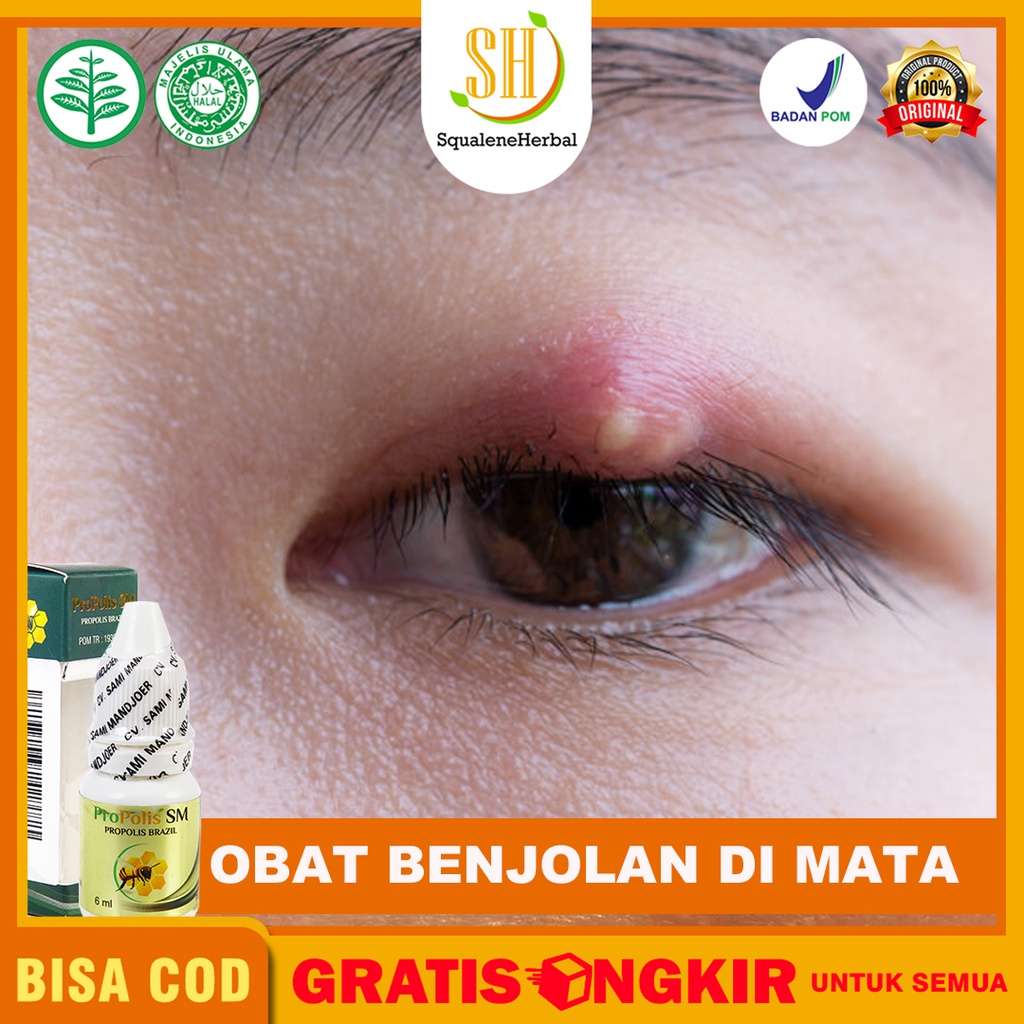 Jual Obat Benjolan Di Mata - Mata Kalazion - Mata Bintitan - Mata ...