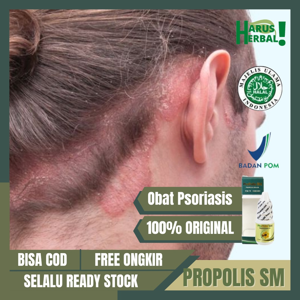 Jual Obat Psoriasis Kulit Kepala, Kulit Kepala Kering Berkerak, Obat ...