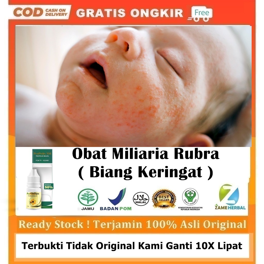 Jual Obat Miliaria Rubra, Obat Biang Keringat Anak/Dewasa, Gatal Bruntusan, Diselangkakan ...