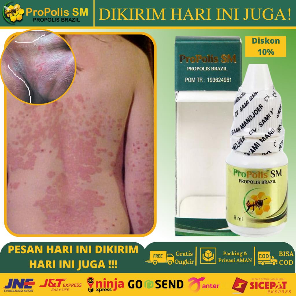 Jual Obat Gatal Seluruh Badan - Gatal Eksim - Obat Gatel Kulit Eksim ... Jual Obat Gatal Seluruh Badan - Gatal Eksim - Obat Gatel Kulit Eksim ...