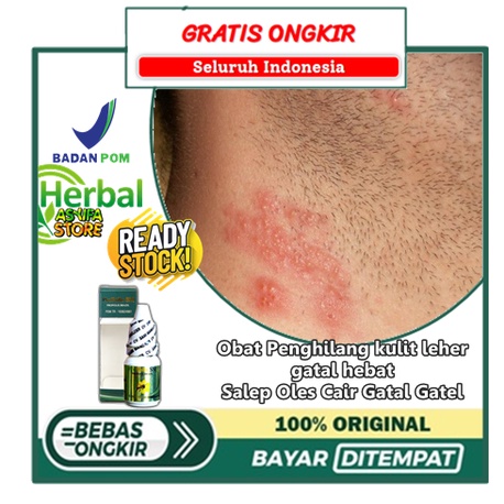 Jual Obat Penghilang Kulit Leher Gatal Hebat \ Salep Oles Cair Gatal ...