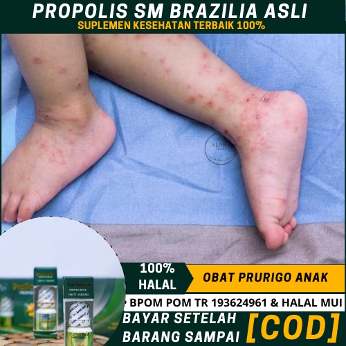 Jual Obat Prurigo Anak, Prurigo Darah Manis, Obat Darah Manis Anak ...