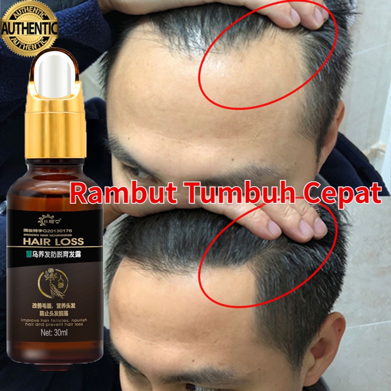 Jual Penumbuh rambut botak Serum penumbuh rambut 30ml Penumbuh rambut cepat Beauty Care Hair ...