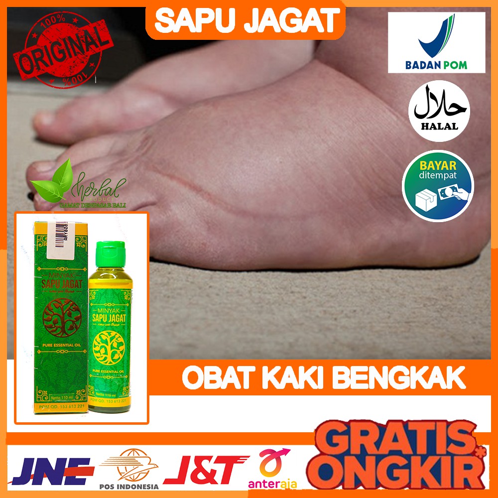 Jual Obat Kaki Bengkak, Tangan Bengkak, Keseleo, Saraf Kejepit - Minyak ...
