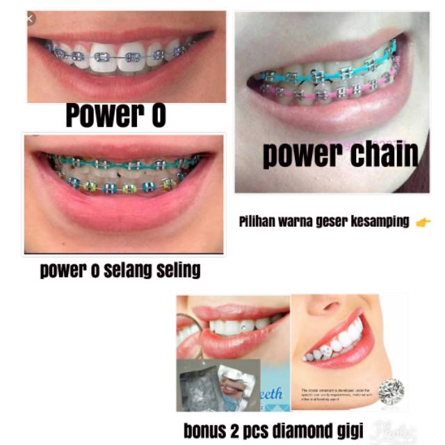 Jual [BISA COD] Behel Lepas pasang POWER O dan POWERCHAIN / behel ...