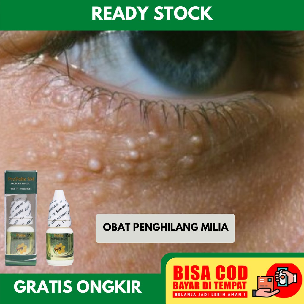 Jual Obat untuk Milia Pada Wajah - Skincare untuk Menghilangkan Milia ...