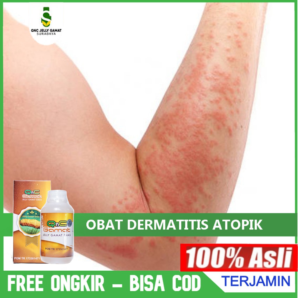 Jual Obat Dermatitis Atopik, Eksim Atopik, Gatal di Kulit Herbal QnC ...