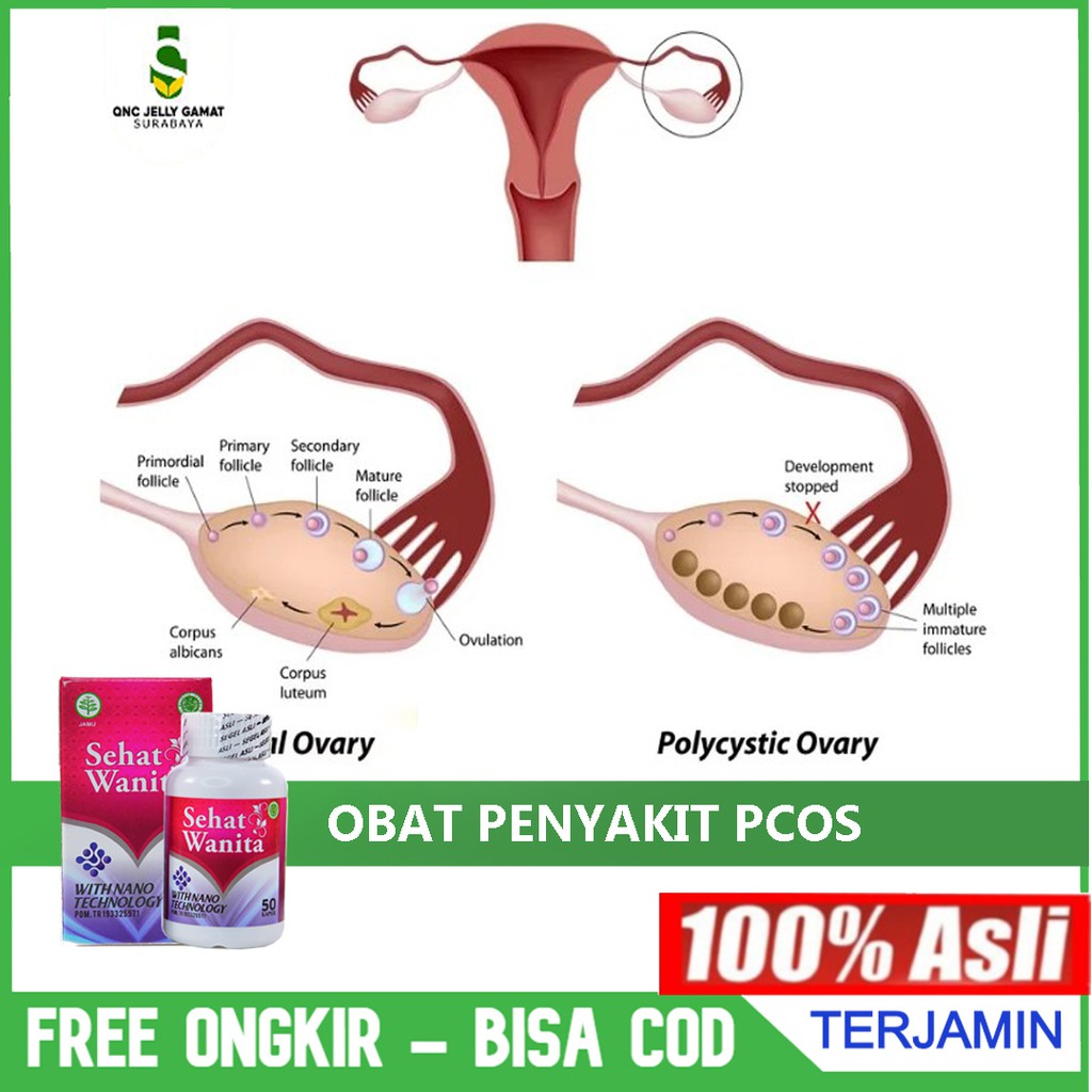 Jual Obat Penyakit PCOS, Miom, Kista, Nyeri Haid, dan Masalah ...