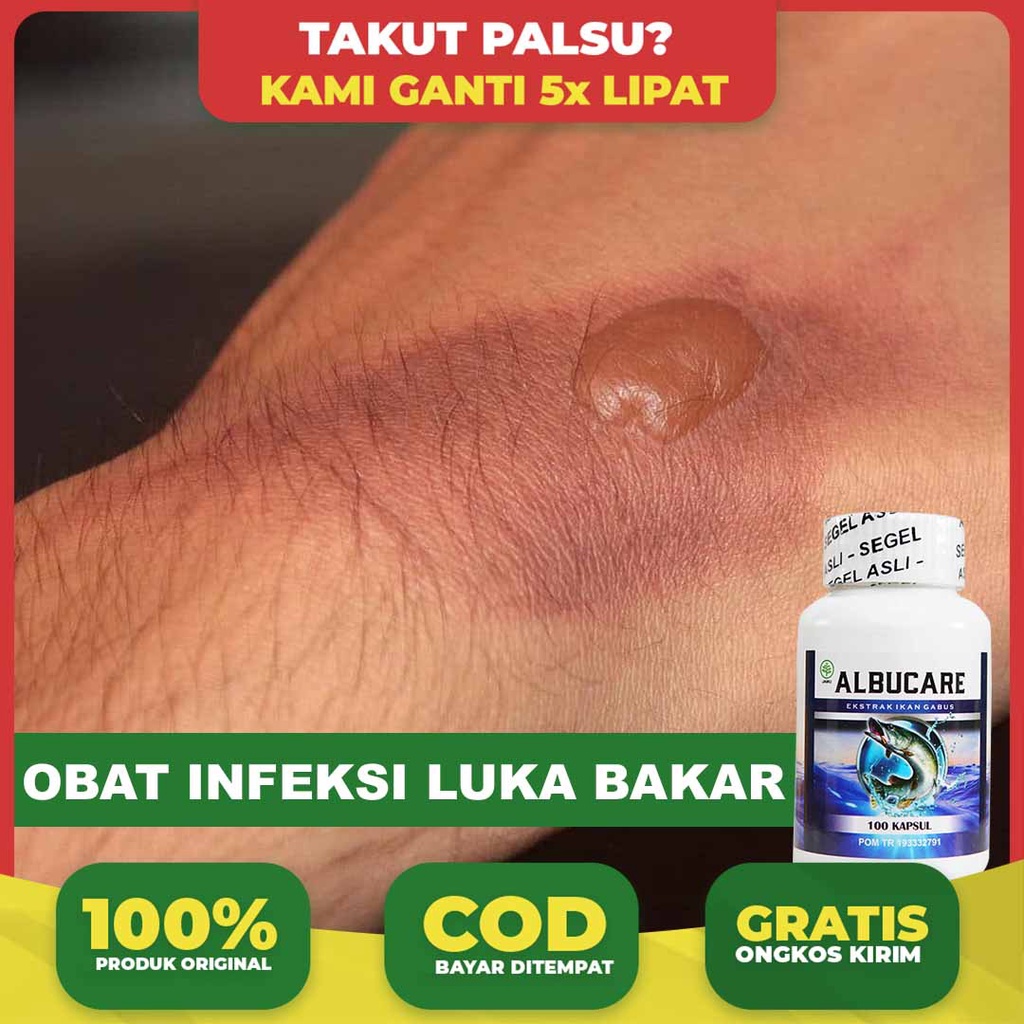 Jual Obat Infeksi Luka Bakar - Luka Bakar Sudah Bernanah - Obat luka ...