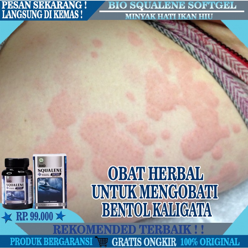 Jual Obat Mengatasi Kaligata/Biduran, Obat Biduran Herbal, Obat Gatal ...