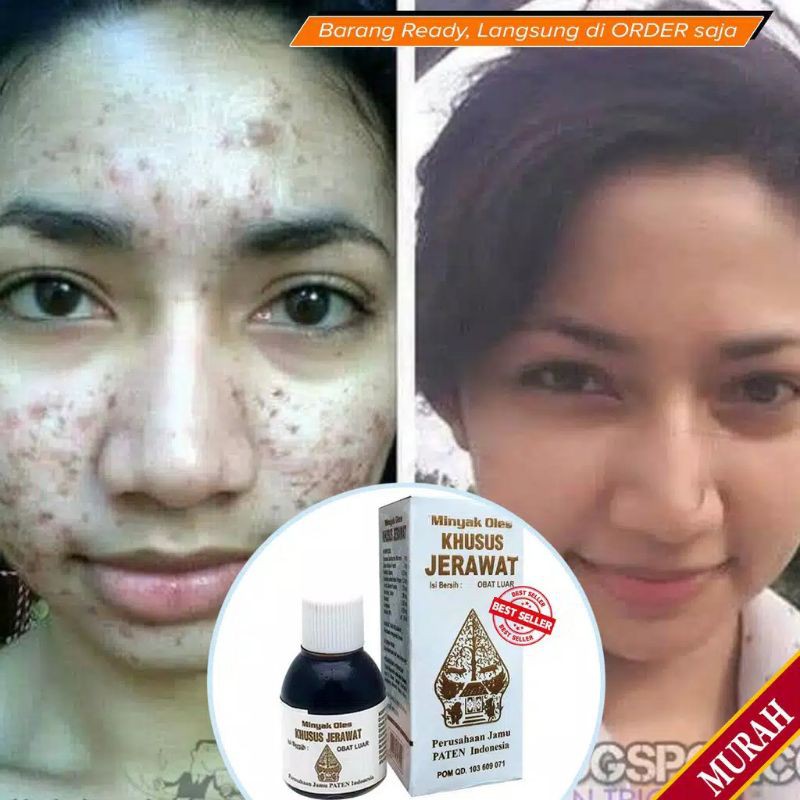 Jual obat jerawat bisul dan luka wayang 100% ampuh original bpom ...
