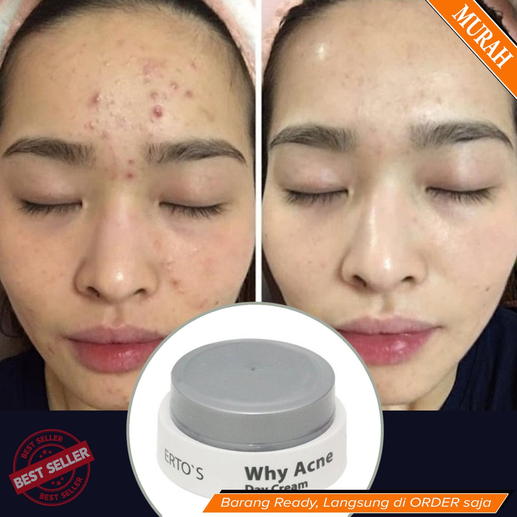 Jual Skincare Scincare Day Cream Krim Penghilang Jerawat Bruntusan ...