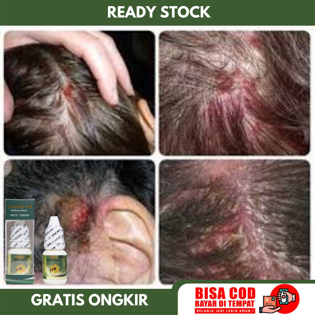 Jual Obat Kulit Kepala Borok - Obat Kepala Gatal Gatel Parah Akibat Infeksi Borok Bernanah ...
