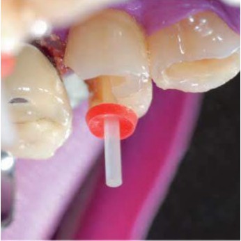 Jual Dental fiber post gigi | Shopee Indonesia