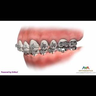 Jual Karet elastik gigi ortho behel dental rubber band elastis karet ...