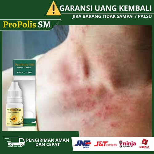 Jual Obat Alergi Gatal Pada Kulit - Obat Bercak Bintik Merah Di Seluruh ...