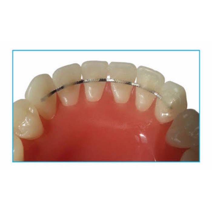 Jual Alice dental Lingual retainer fix retainer FDA kawat gigi retainer ...