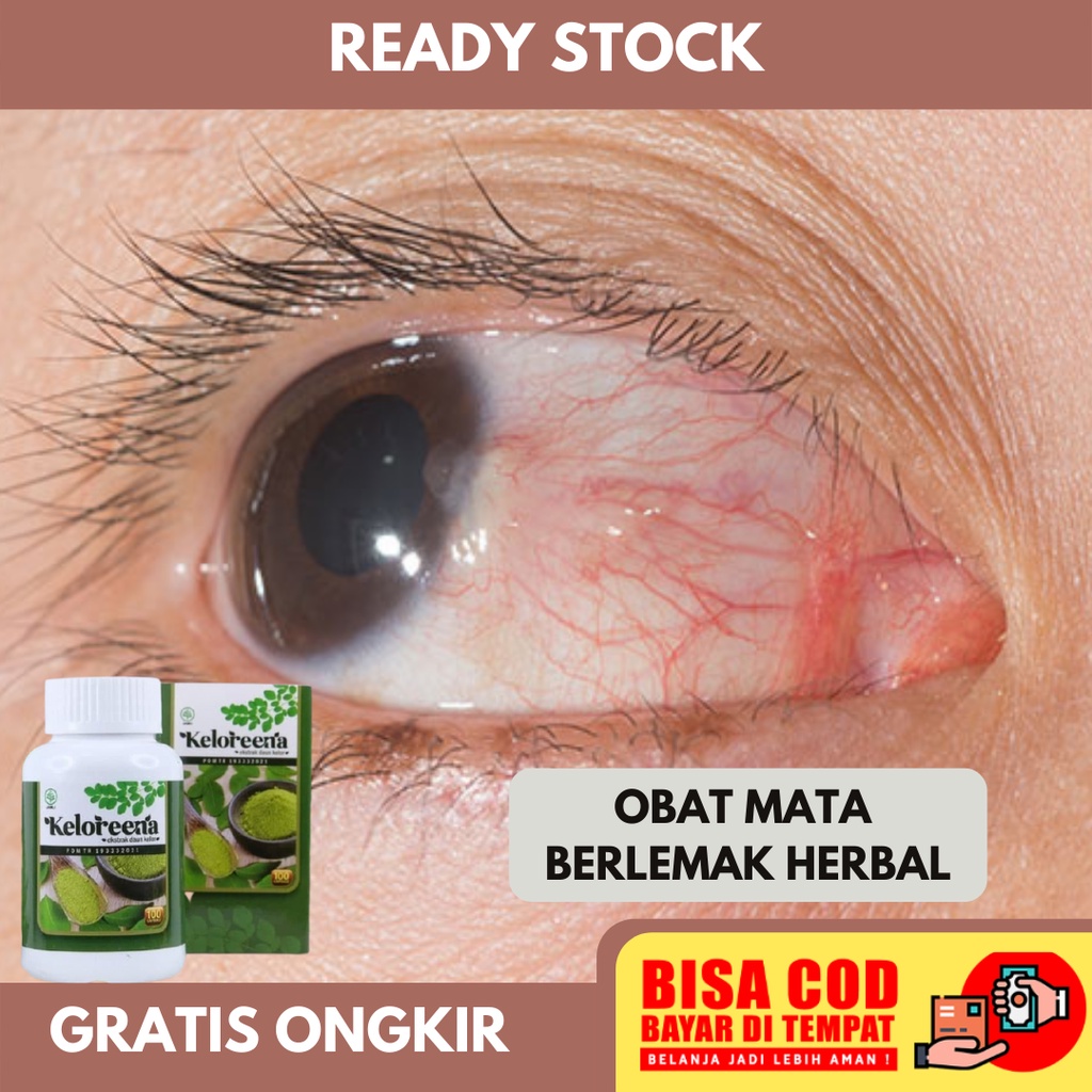 Jual Obat Mata Berlemak, Pterigium, Pterygium, Mata Minus Spesialis Untuk Kesehatan Mata ...