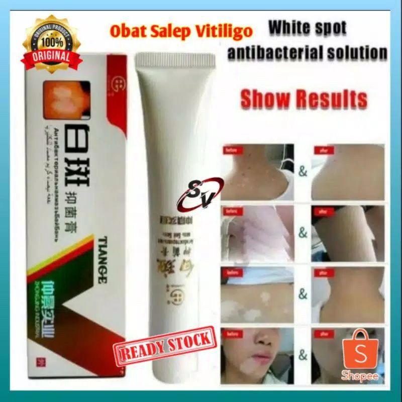 Jual OBAT SALEP VITILIGO BERCAK PUTIH /KULIT BELANG PUTIH Krim Vitiligo ...