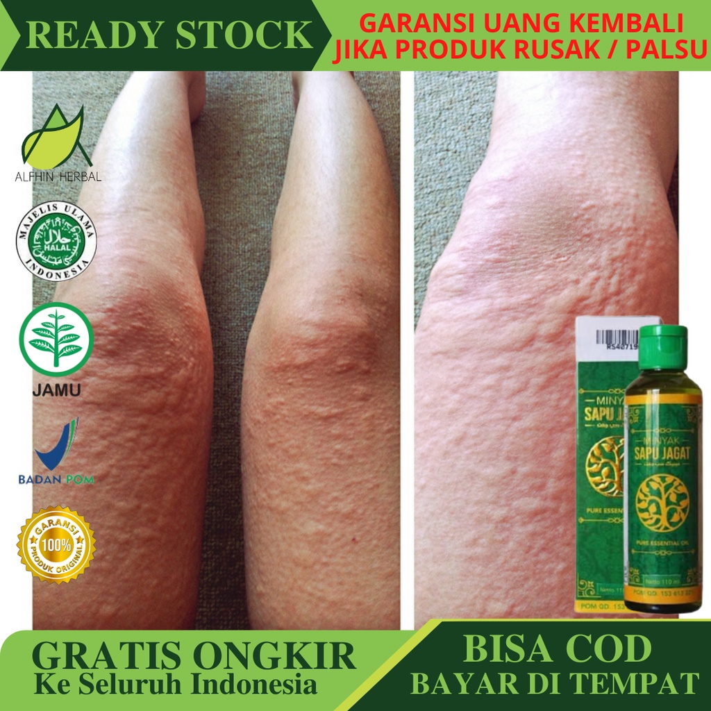 Jual Obat Bentol Gatal Di Paha, Obat Balur Gatal Alergi, Gatal Biduran ...